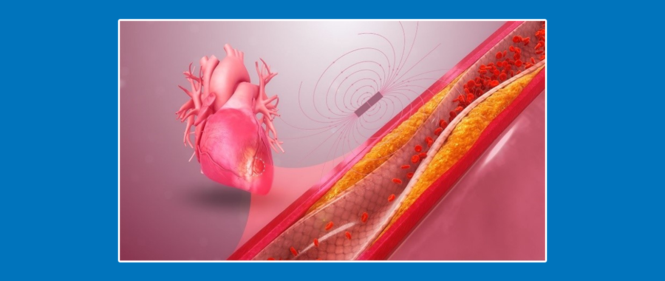 Magnetic Field Regulates Blood Flow in Partially Blocked Arteries ...